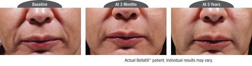 Bellafill Cosmetic Dermal Filler Alexandria, Virginia