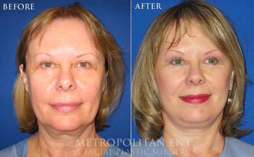 Face Lift in Alexandria, VA | Metropolitan ENT