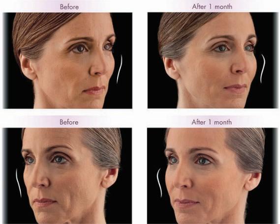 Juvederm Voluma Xc Cheek Filler Alexandria Va