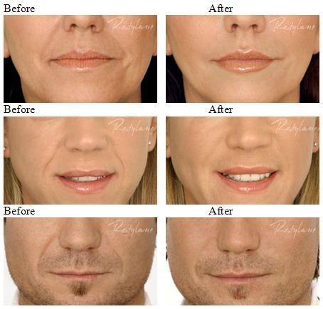 Perlane Side Effects